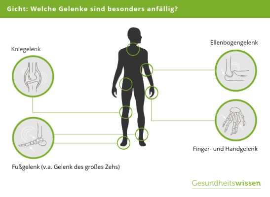 Gicht: Symptome, Diagnose & Behandlung