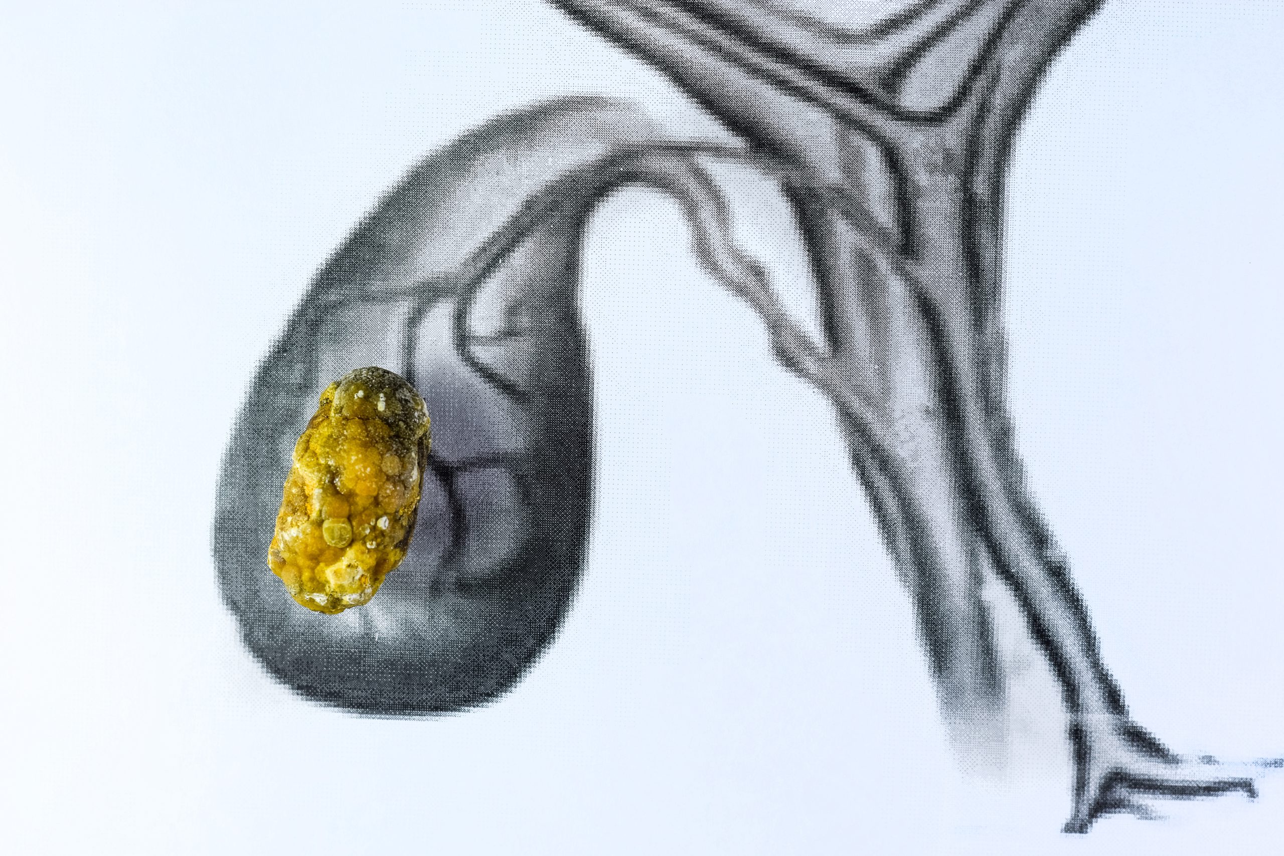 Gallenblase und Gallensteine: Funktion, Symptome & Vorbeugung