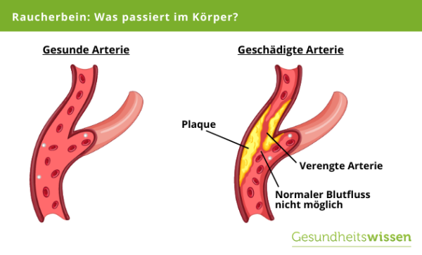 Raucherbein: Periphere arterielle Verschlusskrankheit