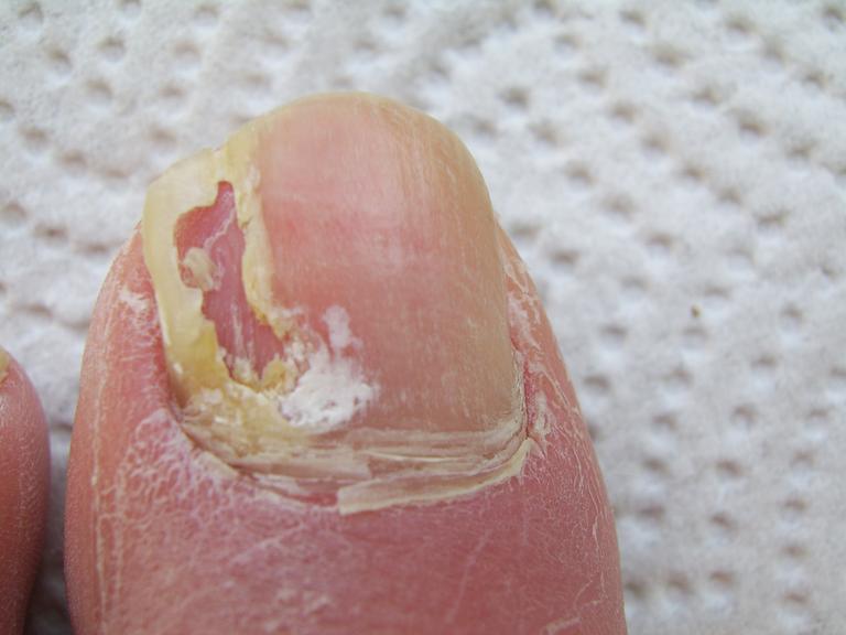 Achtung Nagelpilz Alle Symptome Wie Sie Dagegen Vorgehen Achtung Nagelpilz Alle Symptome Wie Sie Dagegen Vorgehen