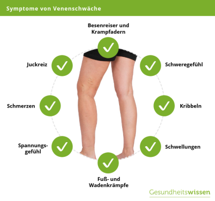 Venenschwäche: Ursachen, Symptomen, Diagnose & Behandlung