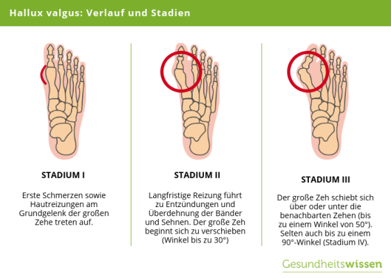 Hallux Valgus - Ursachen, Symptome, Diagnose & Behandlung