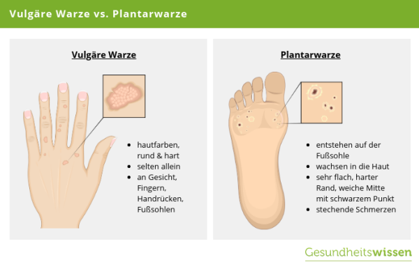 Wie entstehen warzen? ursachen, arten und prävention – warzenarten mit ...