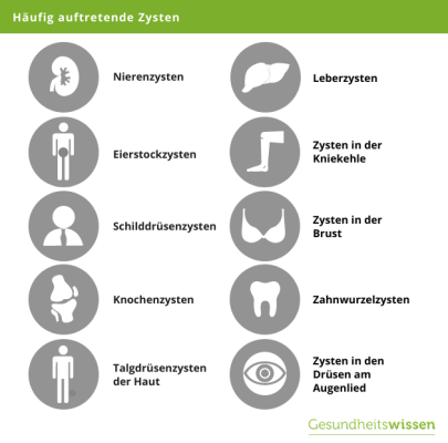 Zysten - Formen, Entstehung & Behandlung